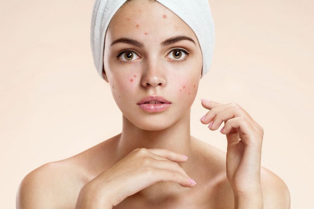 Cuidado de la piel acnéica. Consejos y trucos para combatir las ...